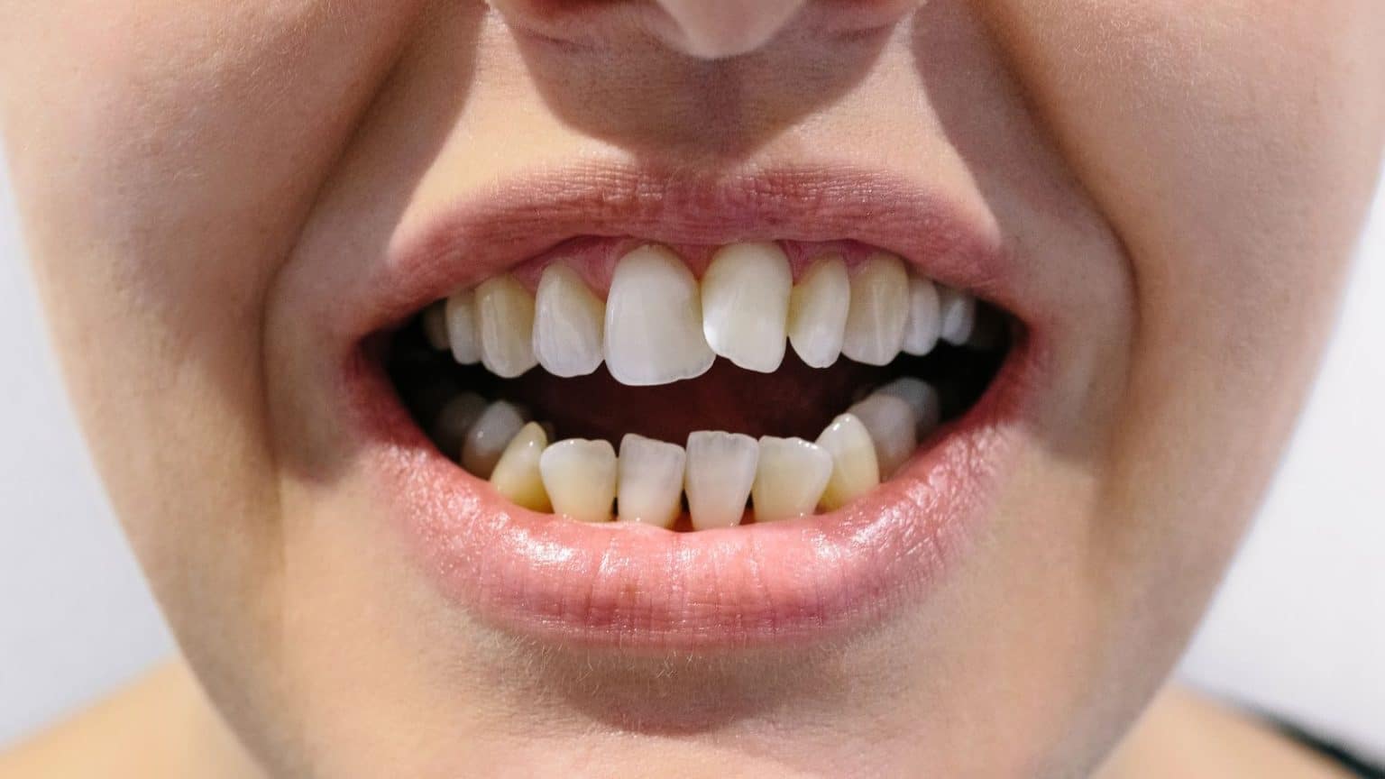 The common causes of wonky teeth – Space Dental